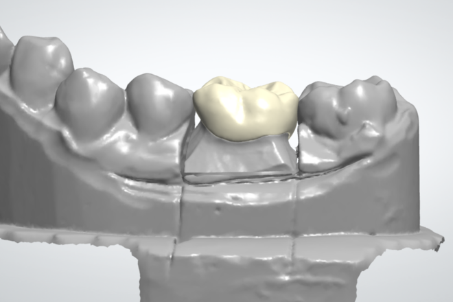 Crown\Bridge - CadCam Masters