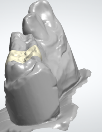 Crown\Bridge - CadCam Masters
