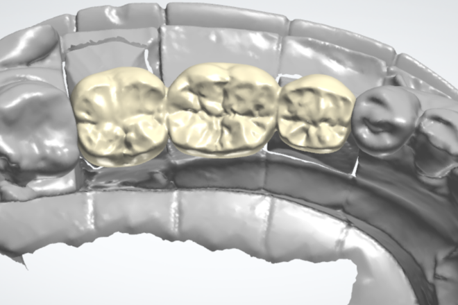 Crown\Bridge - CadCam Masters