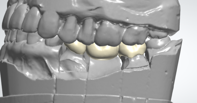 Crown\Bridge - CadCam Masters