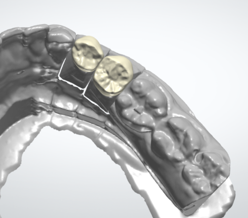 Crown\Bridge - CadCam Masters