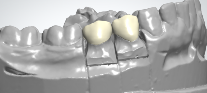 Crown\Bridge - CadCam Masters