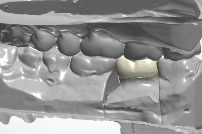 Crown\Bridge - CadCam Masters