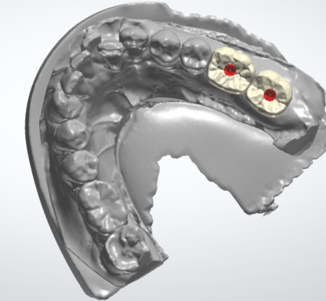 Implant Crown\Bridge - CadCam Masters