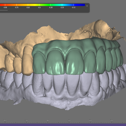 dentogingival framework for full or partial arches - CadCam Masters