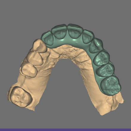 dentogingival framework for full or partial arches - CadCam Masters