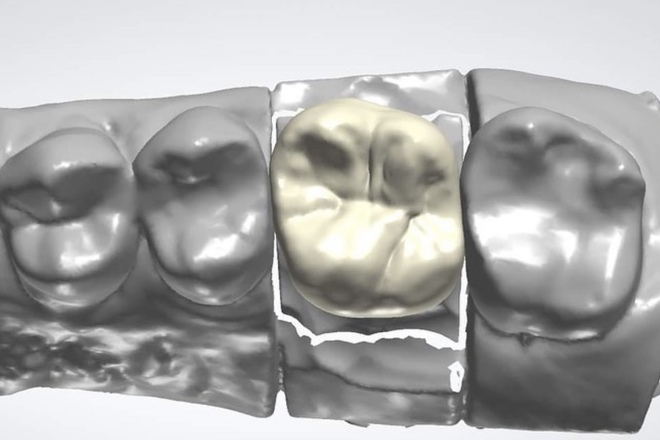 Dens crown cocr pmma,splint... - CadCam Masters
