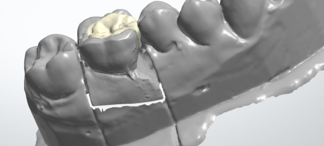 Onlays & inlays - CadCam Masters
