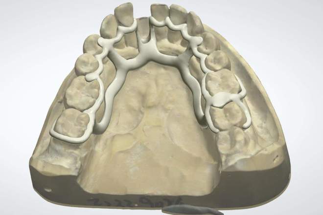 Partial frame - CadCam Masters