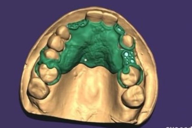 partial frameworks - CadCam Masters