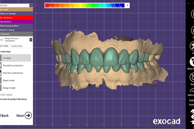 Highly esthetic anterior bridge - CadCam Masters