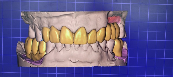 Implant anatomical crown/bridge - CadCam Masters
