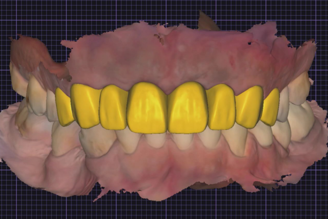 Full Anatomic Crown&Bridge - CadCam Masters