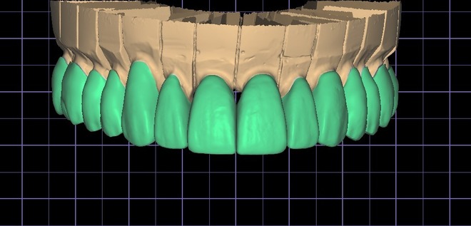 Diseño Dental crown inlay onlay - CadCam Masters