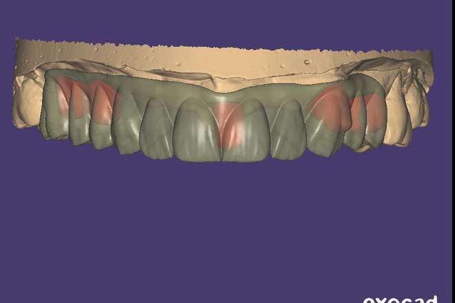 Implant crown and bridge - CadCam Masters