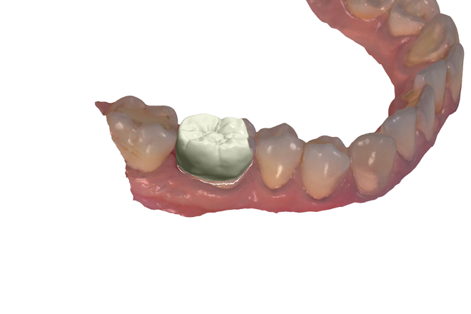 Inlay/onlay design - CadCam Masters