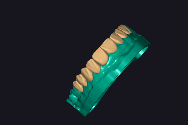 Crowns for implants and teeth, protocol for implants, fixed teeth ...