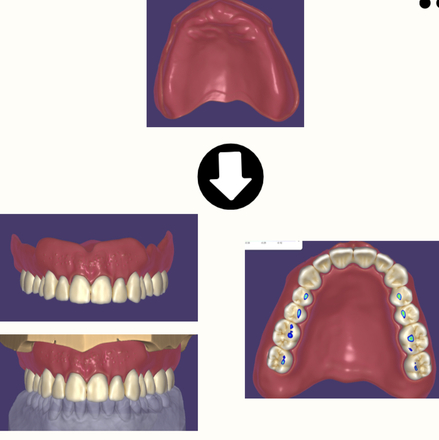 Complete denture - CadCam Masters