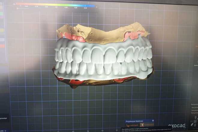 Coping, wax up and monolithic design with Exocad - CadCam Masters