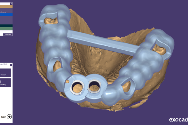 Implant planning - CadCam Masters