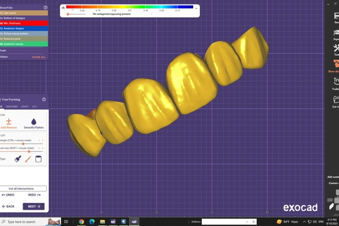 Anterior crown & bridge - CadCam Masters