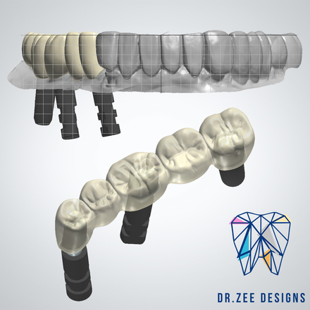 Implant Crown & Bridge. - CadCam Masters