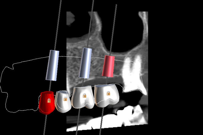 implant planning & surgical guide design - CadCam Masters