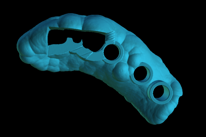 implant planning & surgical guide design - CadCam Masters