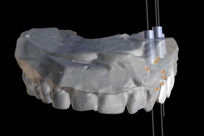 implant planning & surgical guide design - CadCam Masters