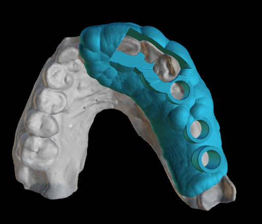 implant planning & surgical guide design - CadCam Masters