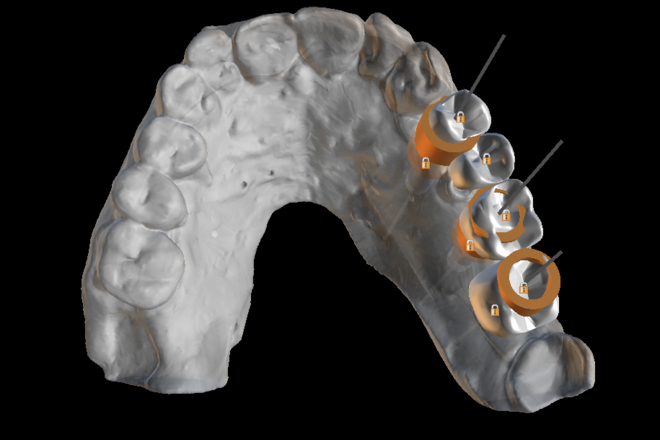 implant planning & surgical guide design - CadCam Masters