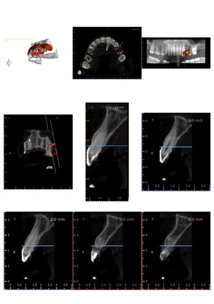 Implant planning and surgical guide - CadCam Masters