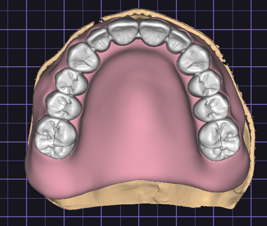 Denture Upper and Lower - CadCam Masters