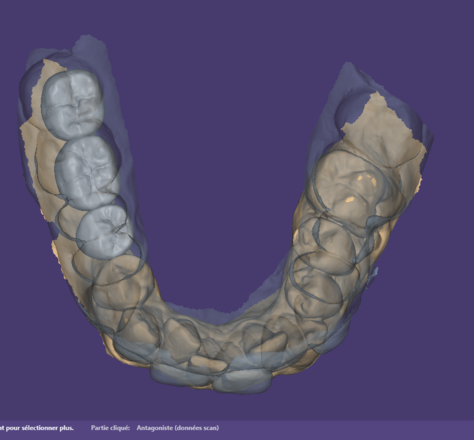 Wax Up - CadCam Masters