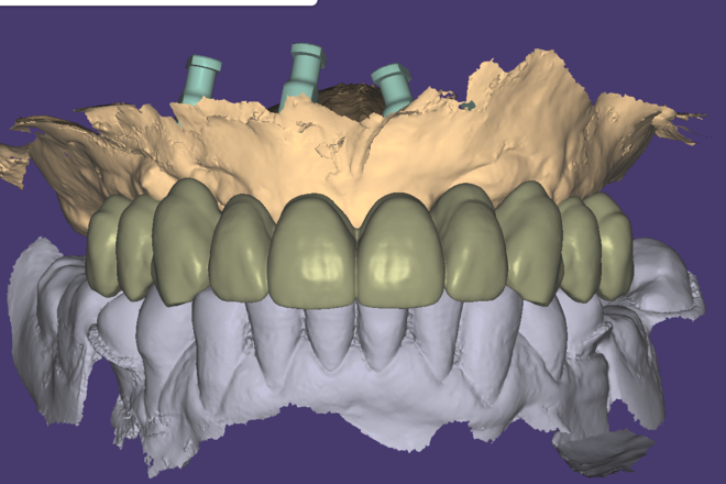 couronne et bridge implantaire - CadCam Masters
