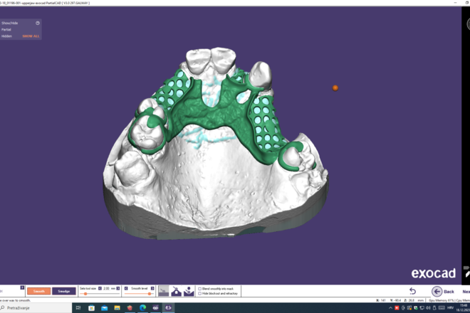 Partial Metal Frameworks - CadCam Masters