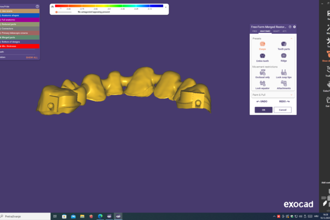 Attachment Combination Metal Crown - CadCam Masters