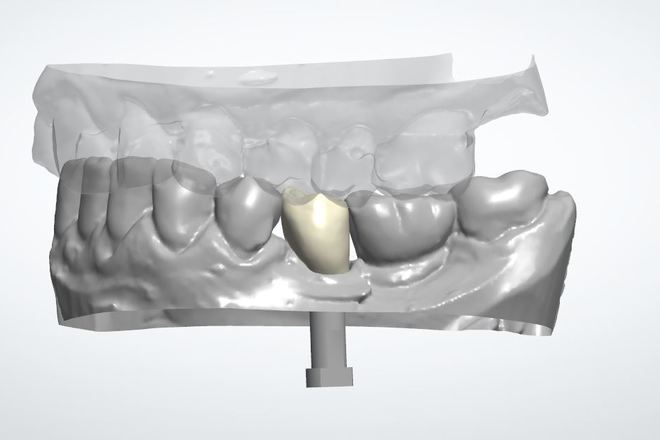 Implant Crown/Bridge - any system - CadCam Masters