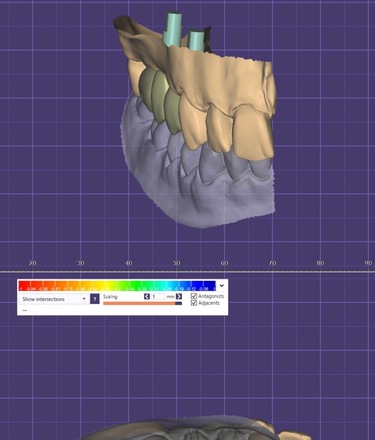 Implant supported bridge - CadCam Masters