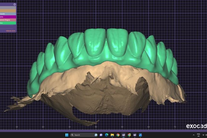 Implant Crown and Bridge - CadCam Masters