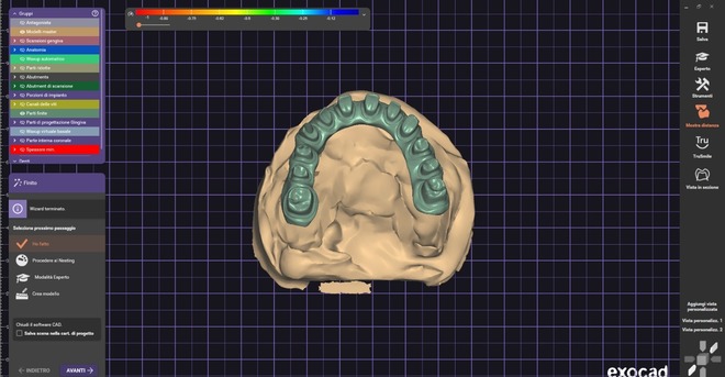Implant Crown and Bridge - CadCam Masters