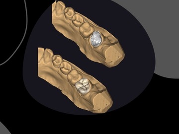inlay onlay e overlay - CadCam Masters
