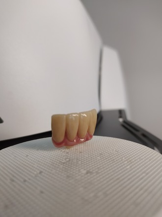 Bridge on implant/or not removable bridge - CadCam Masters