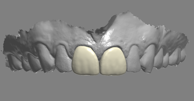 Anterior Crown&Bridge designs - CadCam Masters