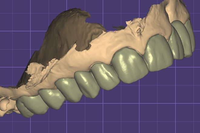 crowns/bridges inlay/onlay provisory - CadCam Masters