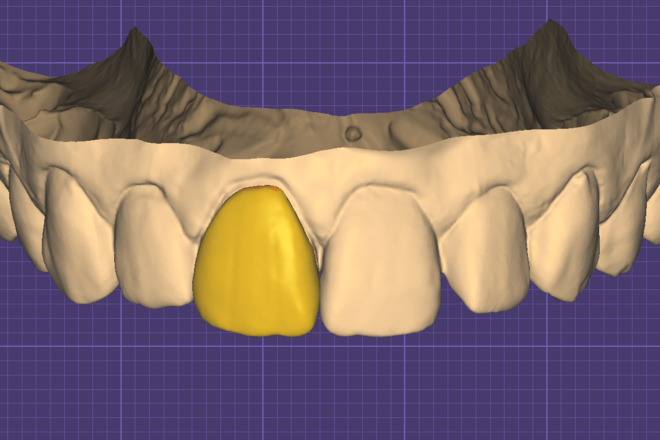 exocad design - CadCam Masters