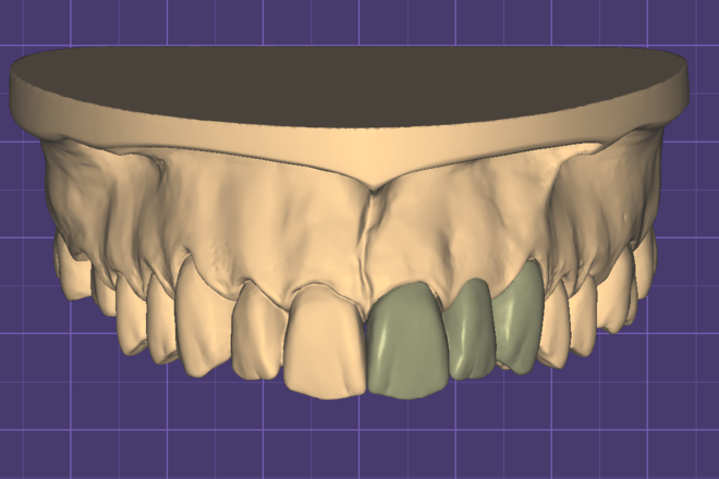 exocad design - CadCam Masters