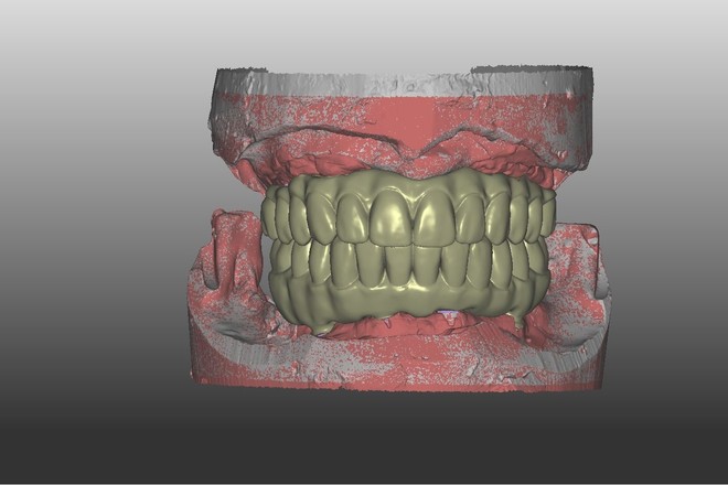 Full arch All on X - CadCam Masters