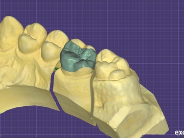 INLAY/ONLAY - CadCam Masters