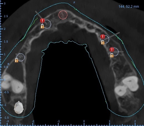 Full Arch Implant Planning - CadCam Masters
